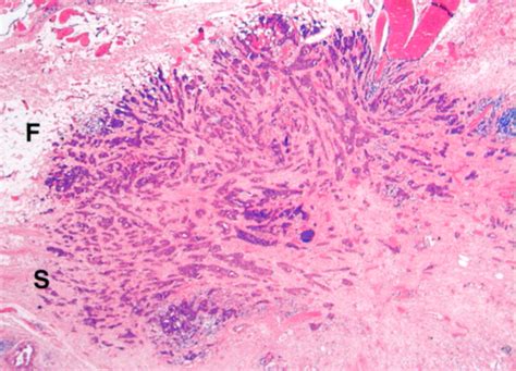 Tumour Behaviour And Spread Flashcards Quizlet