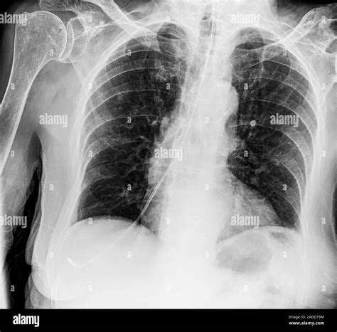 Incorrectly Positioned Nasogastric Tube X Ray Nasogastric Tubes Are Used To Provide Nutrients