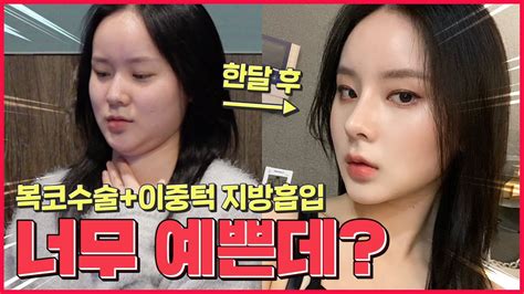 [코성형] 자연스러운데 화려한 신세경 코 완성 美친 옆태 라인 역대급 1달차 비포 애프터│리얼후기│버블tv Youtube