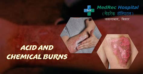 Chemical Burns