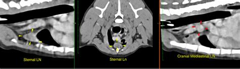 Ct Scan Of The Thorax Showing Enlarged Sternal And Cranial Mediastinal