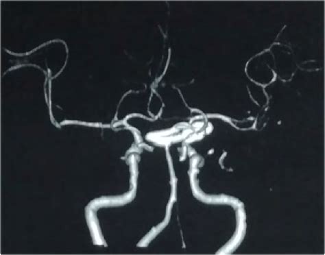 Postoperative Cta Showed No Existence Of Another Aneurysm Or Vasospasm Download Scientific
