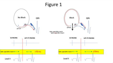 Atrial Flutter Ablation Procedure