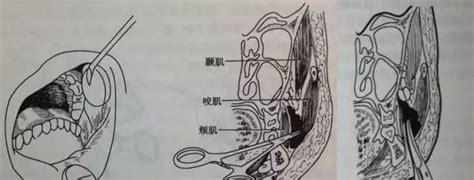 什么是口腔颌面部间隙感染？ 口腔颌面外科 健康宣教 口腔科普 西南医科大学口腔医学院附属口腔医院【官方网站】