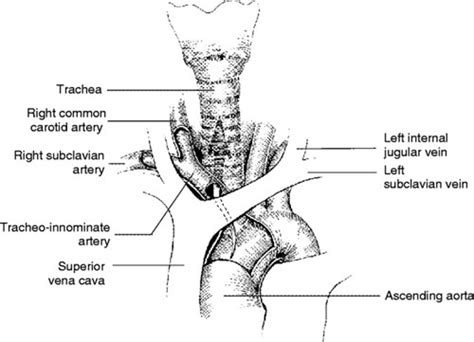 Management Tracheostomy Bleeding Rcemlearning India