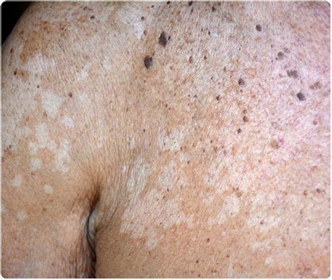 Idiopathic Guttate Hypomelanosis Igh Differential Diagnoses