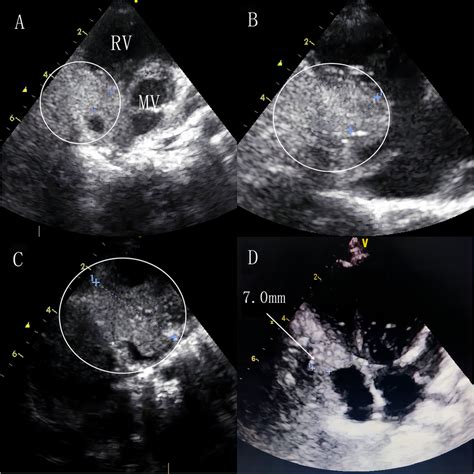 A Transthoracic Echocardiogram Obtained In The Parasternal Non Standard Download Scientific