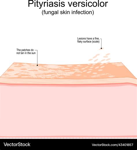 Pityriasis Versicolor Fungal Skin Infection Vector Image