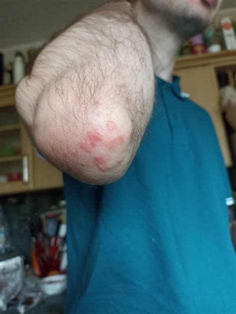 Bumps On My Elbow Rmedical