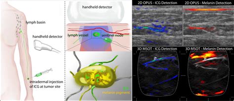 Melanoma Sentinel Lymph Node Biopsy Recovery Essential Care Guide