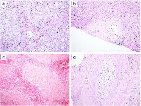Histopathological Findings Of Liver Biopsies A Central Perivenulitis