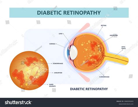 Fundus Over 391 Royalty Free Licensable Stock Vectors And Vector Art Shutterstock