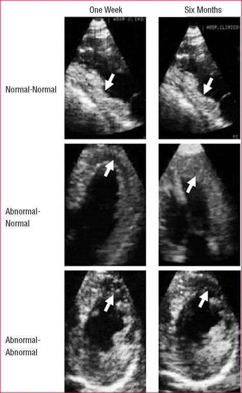 Abnormal Myocardial Perfusion After Infarction In Patients With