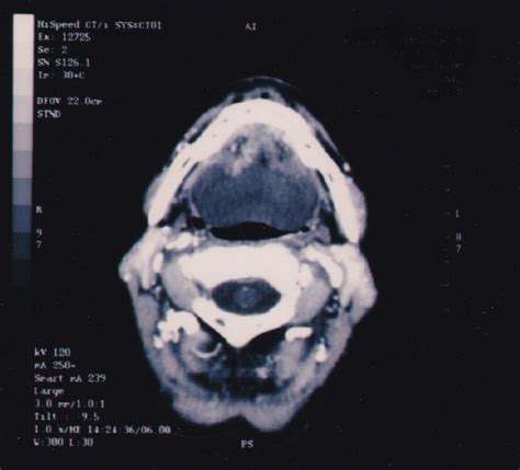 Maxillofacial Computed Tomography Scan Axial View Frame Showing