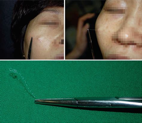 Complications Of Thread Lift And How To Manage Thread Protrusion Inf