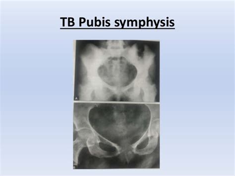 Tuberculosis Of Bone And Joints