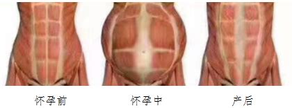 产后康复之腹直肌分离篇 西安凤城医院 官网 急救电话029 86530966