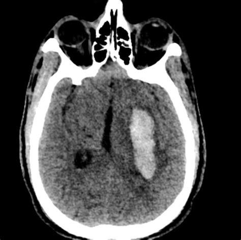 Axial Ct Brain Showing A Left Parieto Temporal Hematoma Download