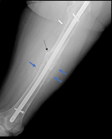 Frontal Radiograph 14 Months Later Shows Intramedullary Nail In Left Download Scientific