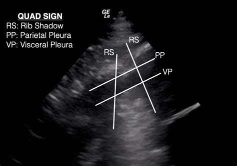 Confused About How To Perform Lung 🫁 Ultrasound And All Those Signs