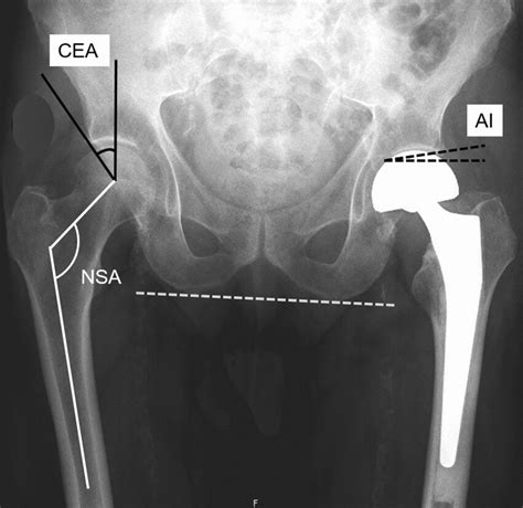 Standard Pelvic Radiograph With Delineated Acetabular Center Edge Angle Download Scientific
