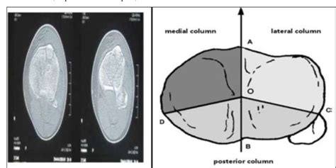 Figure 1 From Computed Tomography Based Three Column Classification Aid