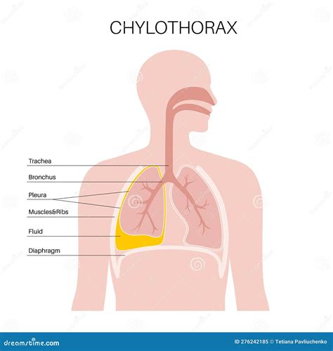 Chylothorax Anatomical Poster Cartoon Vector 276242269