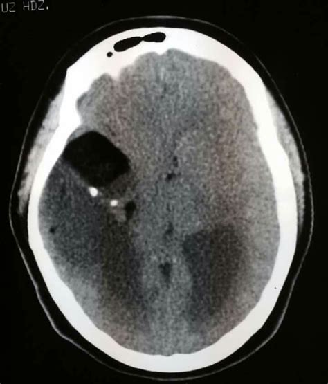 Ruptured Dermoid Radiology Brain Anatomy Human Body