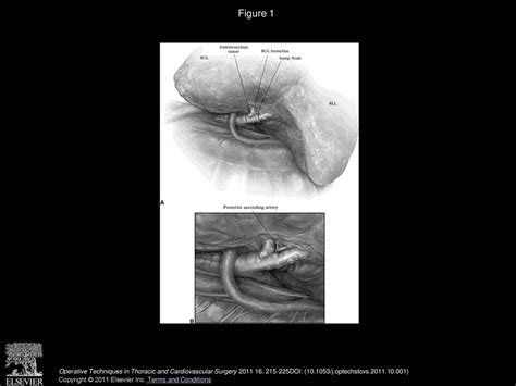 Parenchymal Sparing Lung Resections Technique Of Sleeve Resections Ppt Download