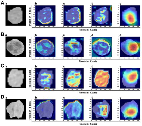 Mvi Tr A Transformer Based Deep Learning Model With Contrast Enhanced Ct For Preoperative