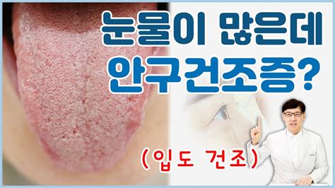 눈이 아프고 눈물이 너무 많이 나는데 안구건조증이라네요 Youtube