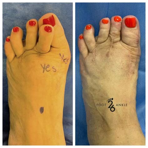 Hammertoe Surgery Cross Over Toe 26 Foot And Ankle