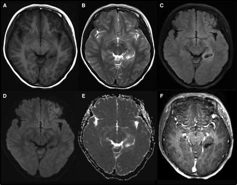 Pediatric Type Diffuse Low Grade Glioma MAPK Pathway Altered In A Download Scientific Diagram