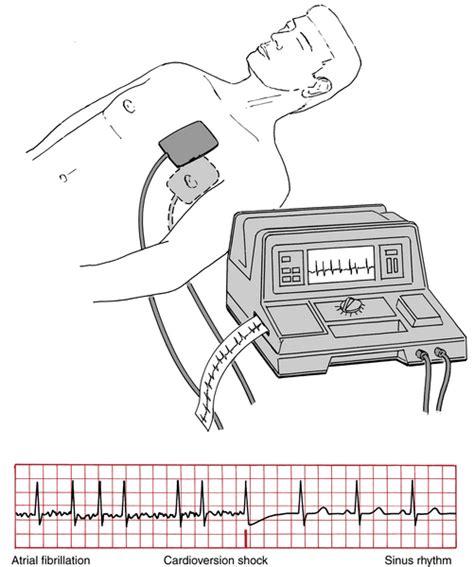 Supraventricular Arrhythmias Part Ii Atrial Flutter And Atrial