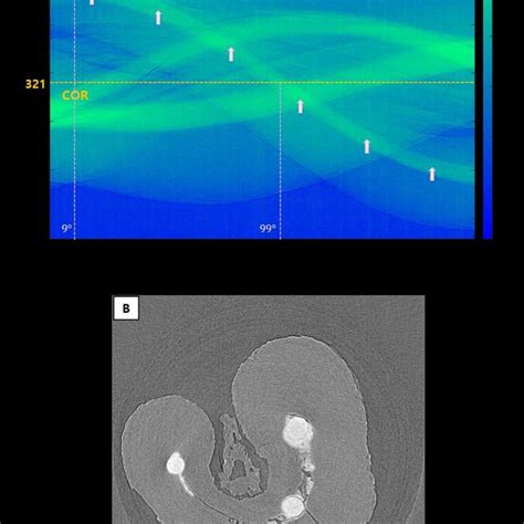 The Sinogram And Reconstruction Image After Correcting Rotation Axis