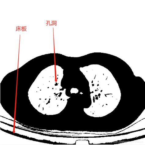 肺实质分割 csdn博客