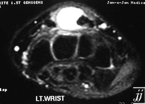 Msk Large Dorsal Wrist Ganglion Cyst Or Extensor Tendons 2 Radioogle