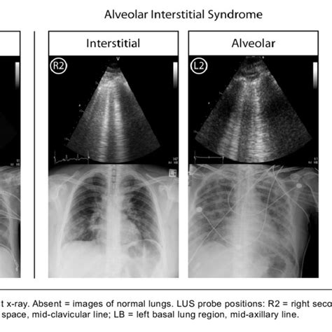 Comparison Of Lung Ultrasound Chest X Ray And Physical Examination In