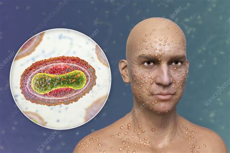 Smallpox Virus Infection Illustration Stock Image F036 6650 Science Photo Library