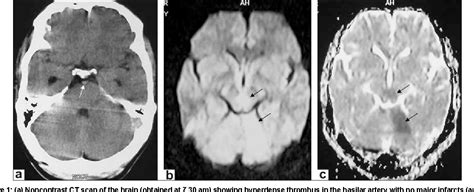 Figure 1 From Intra Arterial Thrombolysis In Basilar Artery Occlusions