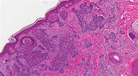 Basal Cell Carcinoma Of The Skin Ottawa Atlas Of Pathology