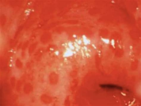 Trichomoniasis Pictures Causes Treatment