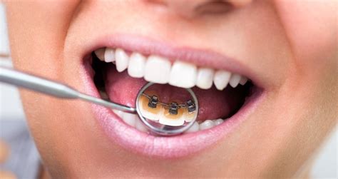 Braces That Work From Behind The Teeth Lingual Braces