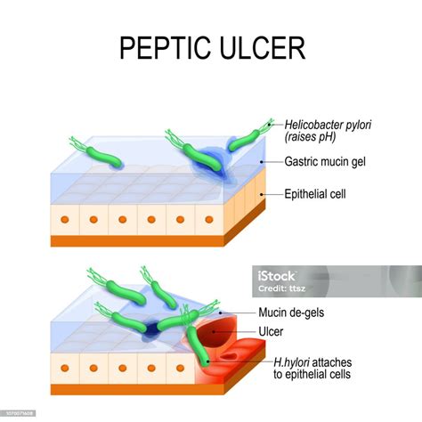 위 궤 양 그리고 세균성 감염입니다 이 다이어그램에 헬리코박터 Pylor 메커니즘 건강관리와 의술에 대한 스톡 벡터 아트 및 기타 이미지 건강관리와 의술 건강한 생활