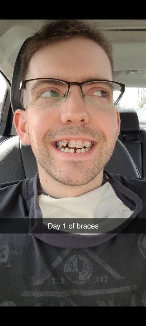 6 Months Since Braces Removal Finally Shaved Decided To Update 😅 R Braces