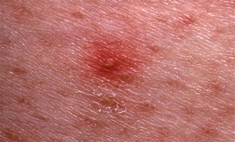 Breast Cancer Rash Cancerwalls