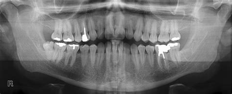Dental Object Detection Model V1 2021 12 05 6 27pm By Kajol Daiya