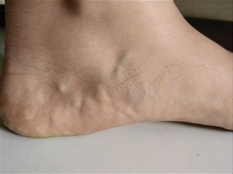 Current Understanding Of Frictional Dermatoses A Review Indian Journal Of Dermatology