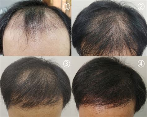 植了还会脱？为什么植发后还掉发？脱发问题真的解决不了吗？ 知乎
