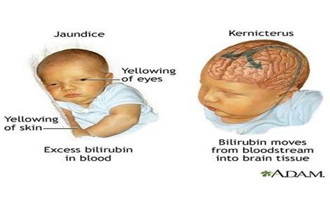 Understanding Neonatal Jaundice Community Practitioner